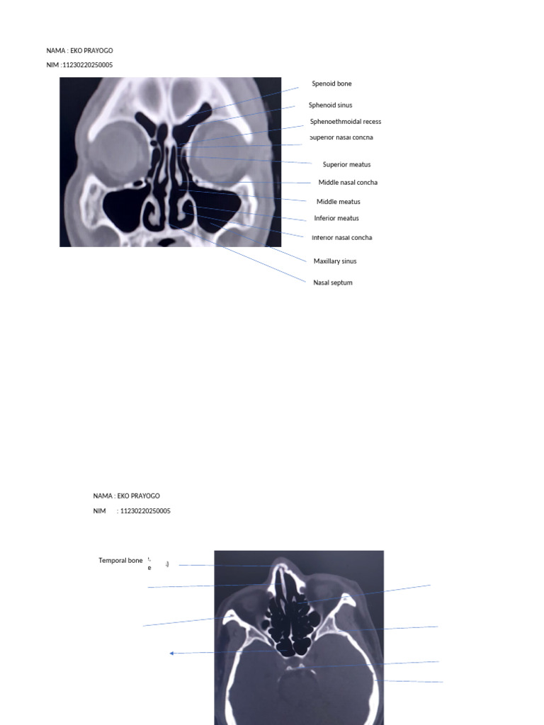 ANATOMI Ct-Scan NASAL | PDF