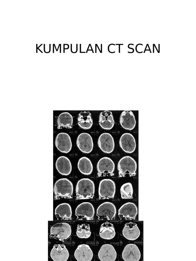 Kumpulan Case CT Scan | PDF