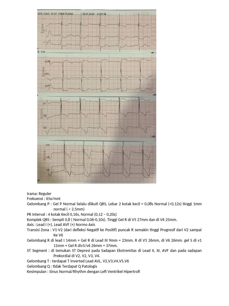 Sinus Rhythm dengan Hipertrofi Ventrikel Kiri | PDF