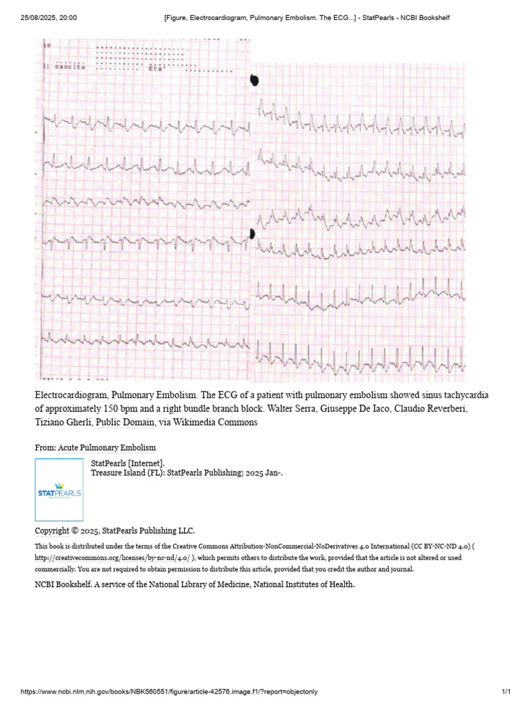(Figure, Electrocardiogram, Pulmonary Embolism. The ECG ...