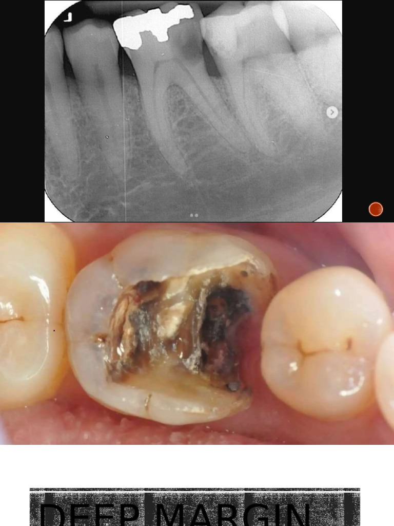 Deep Margin Elevation in Dentistry | PDF | Periodontology | Mouth