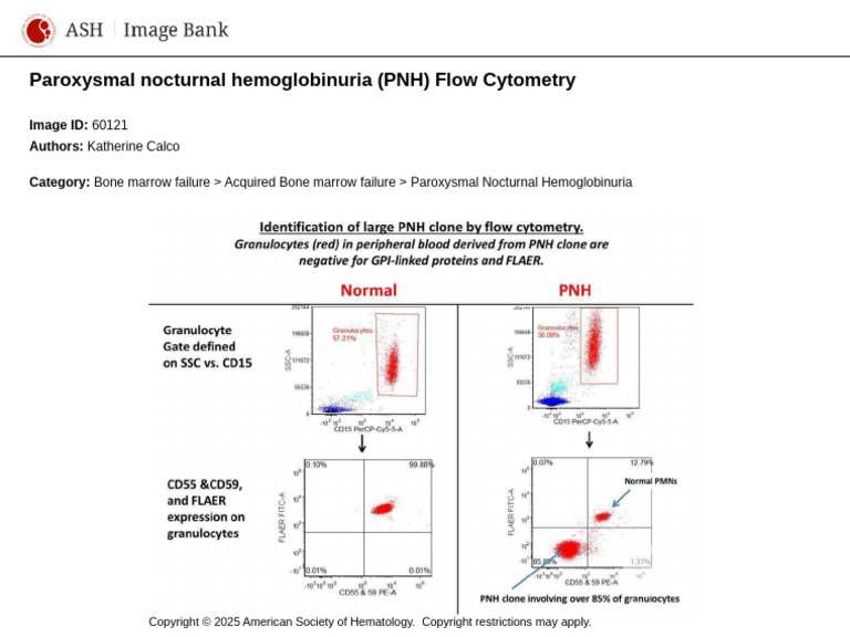 60121-Paroxysmal Nocturnal Hemoglobinuria (PNH) Flow Cytometry | PDF