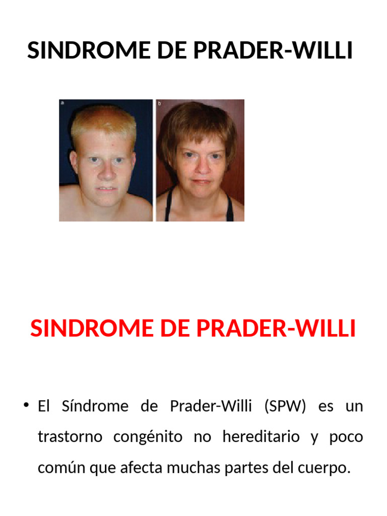 Síndrome de Prader-Willi: Síntomas y Tratamientos | PDF | Enfermedades ...