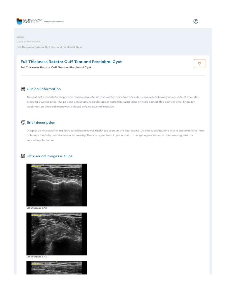 Full Thickness Rotator Cuff Tear and Paralabral Cyst: Clinical ...