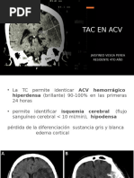 Escala ASPECTS | PDF