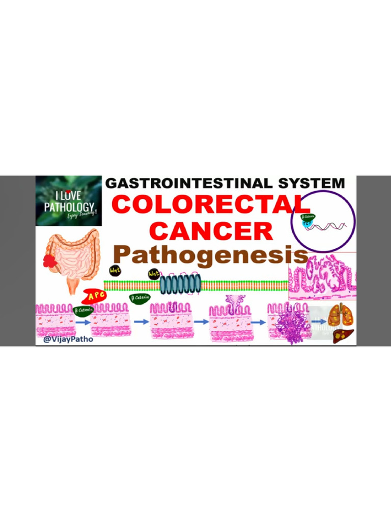 Colon Cancer | PDF