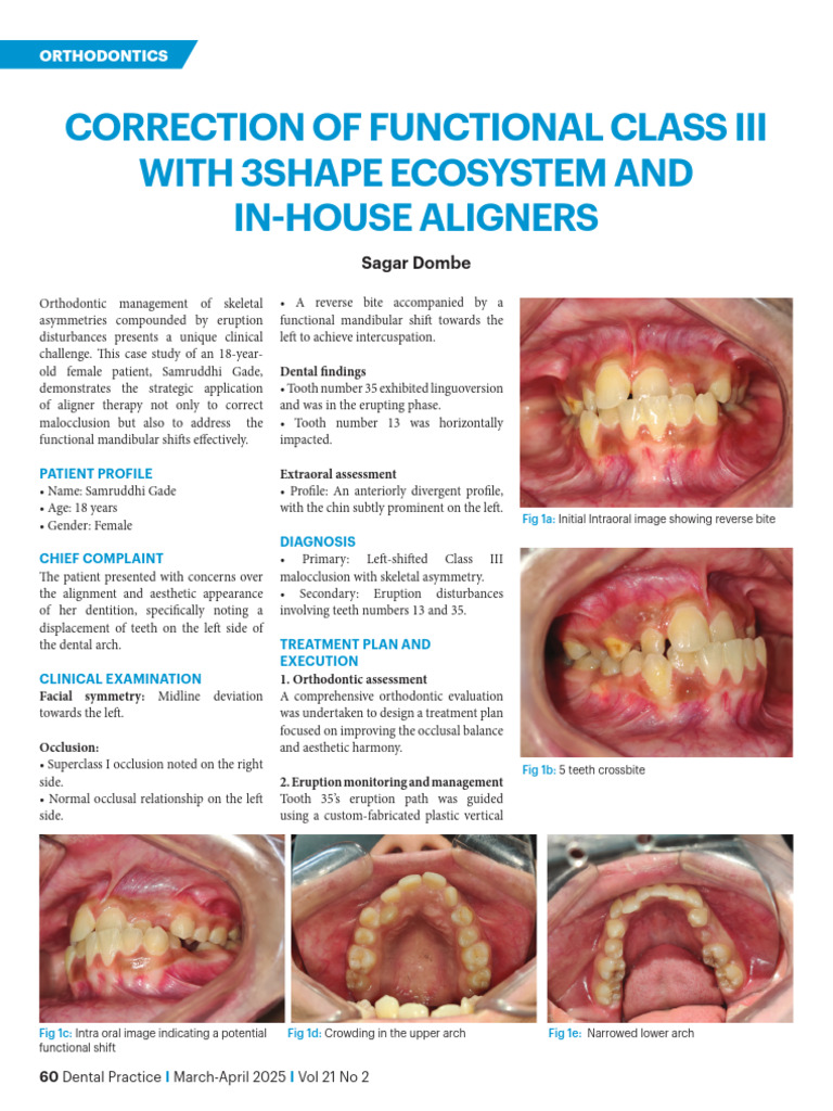 Class III Malocclusion Correction with Aligners | PDF | Orthodontics ...