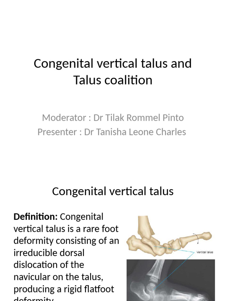 Congenital Vertical Talus and Talus Coalition | PDF | Foot ...