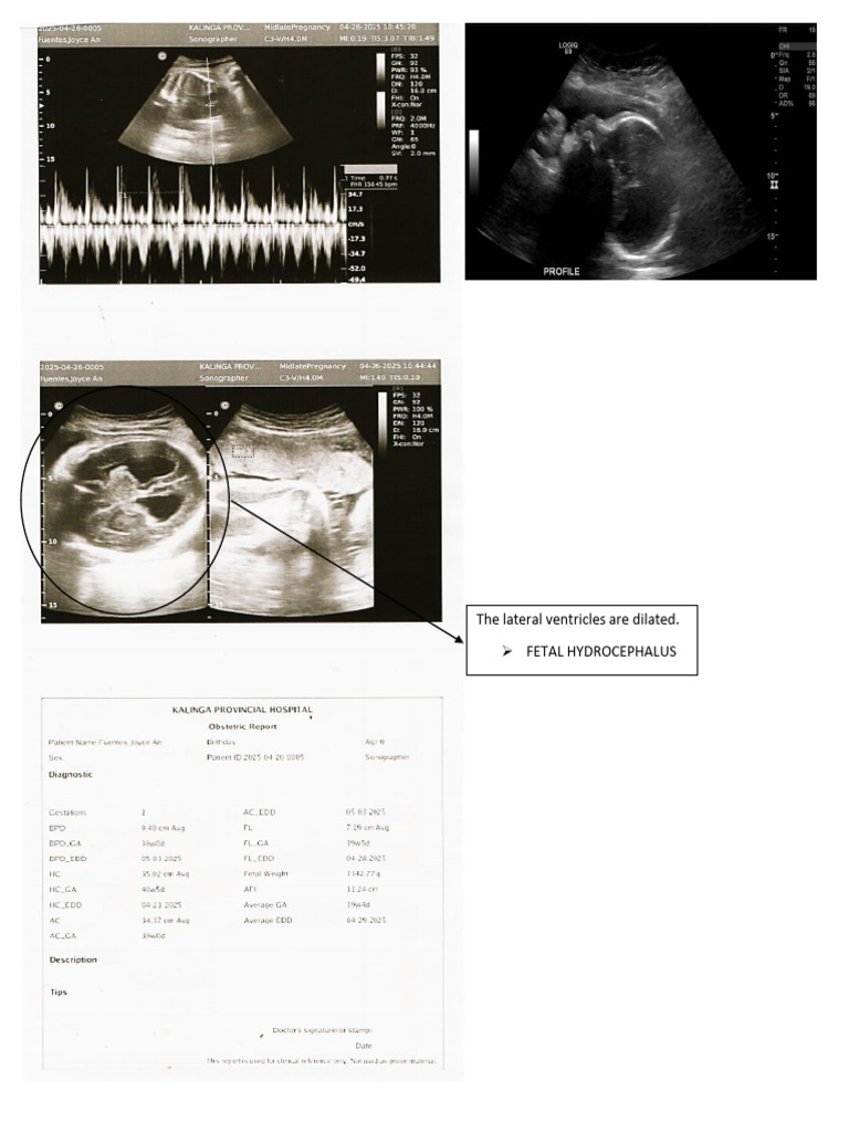 Fetal Hydrocephalus | PDF
