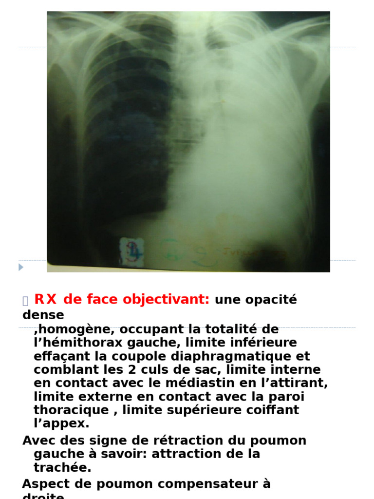 Opacités en lâcher de ballon pulmonaire | PDF | Poumon | Thorax