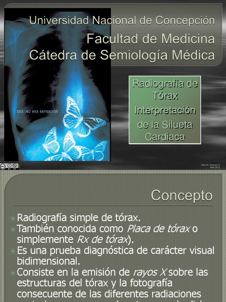 Interpretación RX Torax - Silueta Cardiaca V2 | PDF | Corazón | Aorta