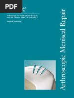FiberStitch™ Meniscal Repair Technique | PDF | Surgical Suture ...
