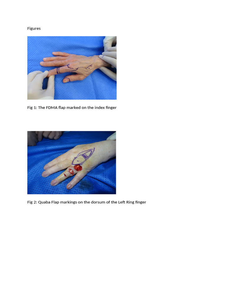 Flap Techniques for Finger Reconstruction | PDF