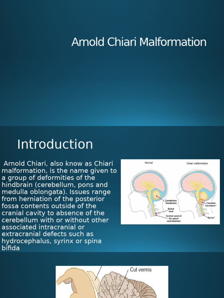 Arnold Chiari Malformation Overview | PDF | Neurology | Diseases And ...