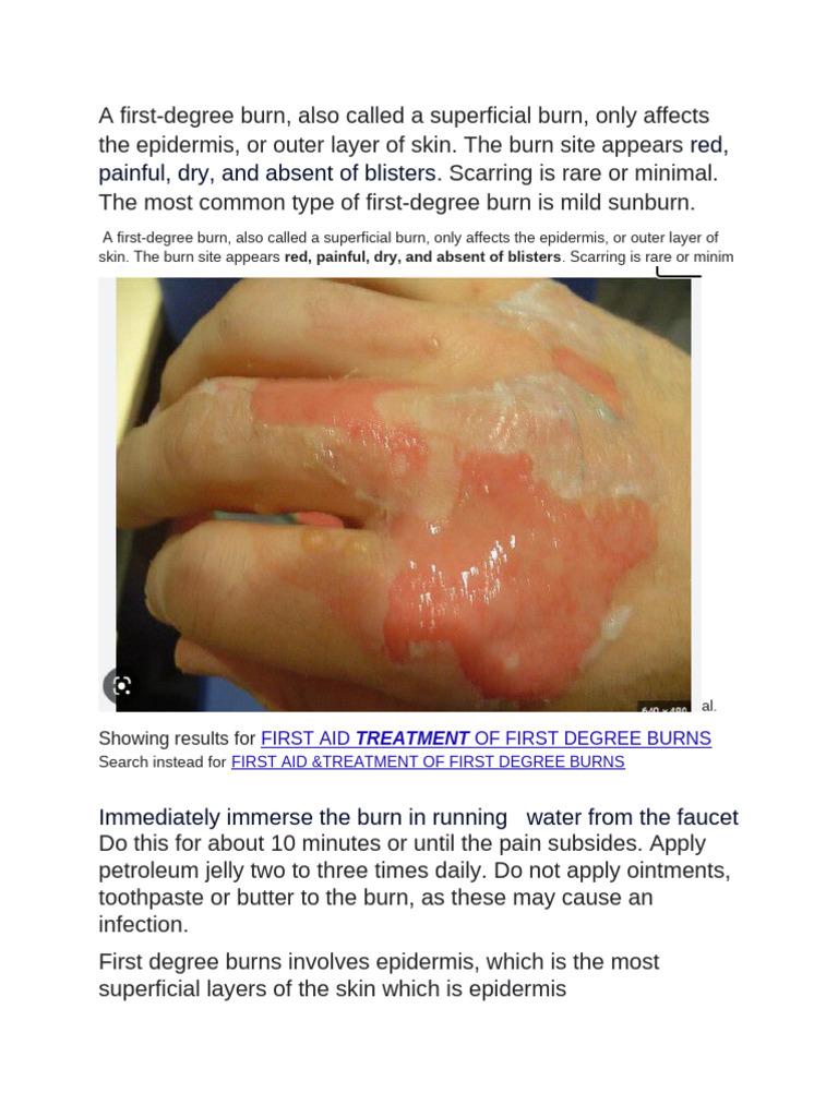 First Aid Burns To Presented in Audit Course Real | PDF | Burn | Skin