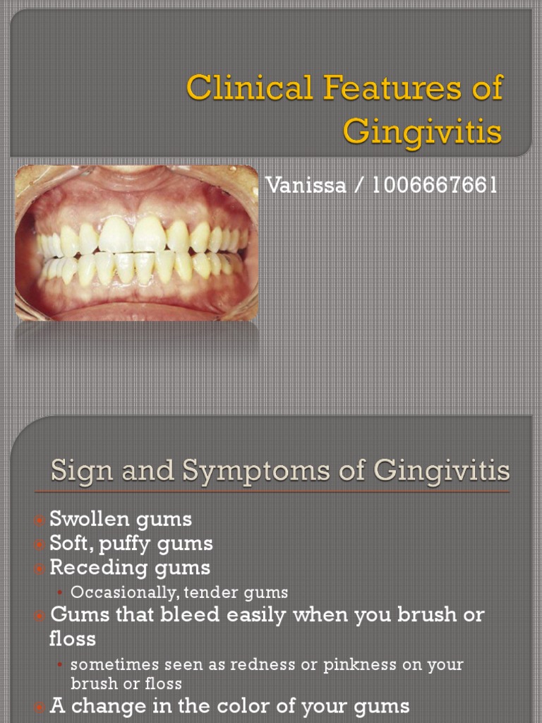 Clinical Features of Gingivitis | PDF | Mouth | Medical Specialties