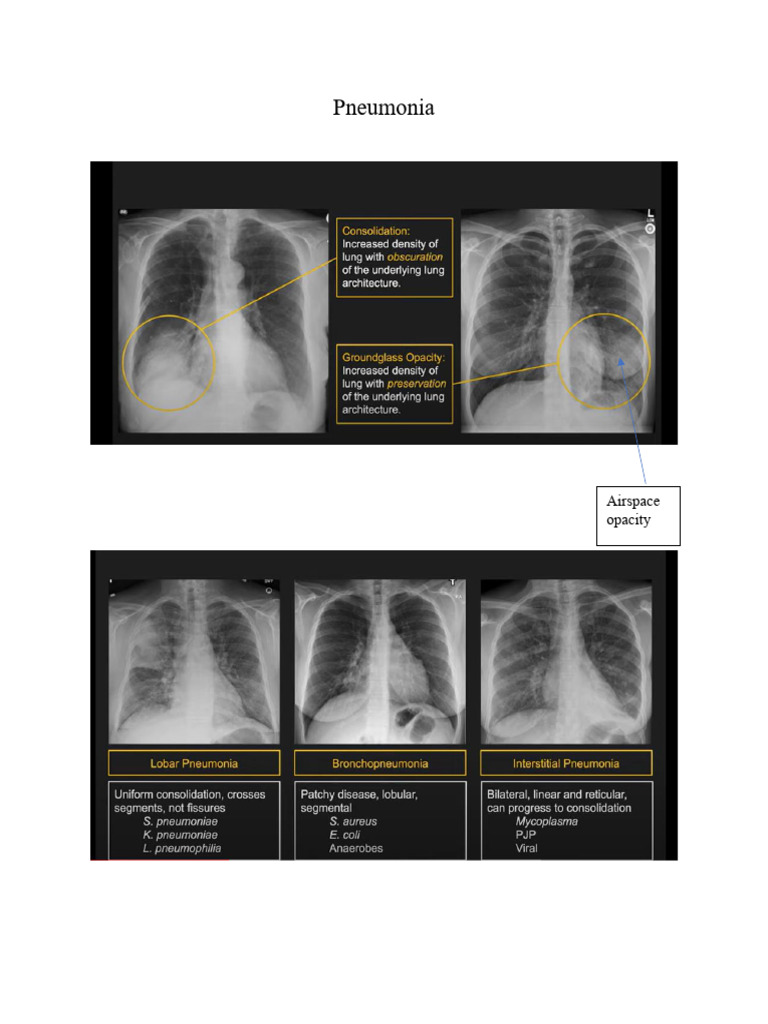 Understanding Non-Resolving Pneumonia | PDF