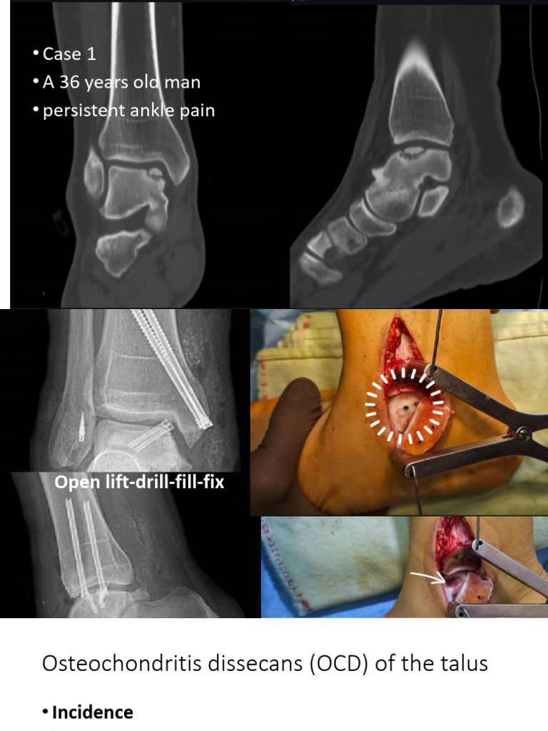 Talus Osteochondritis Dissecans Overview | PDF