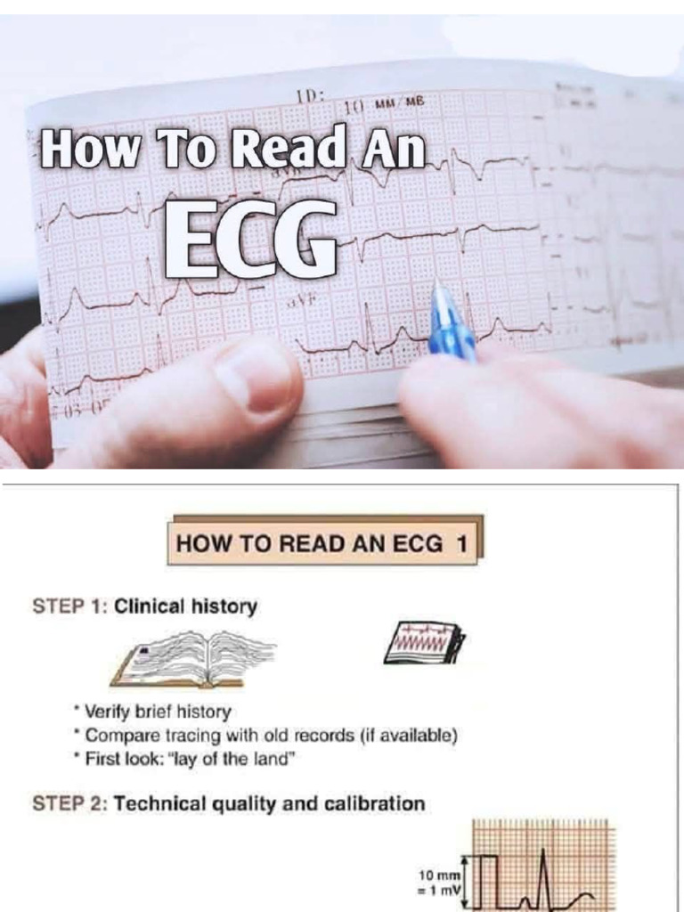 How To Read ECG | PDF