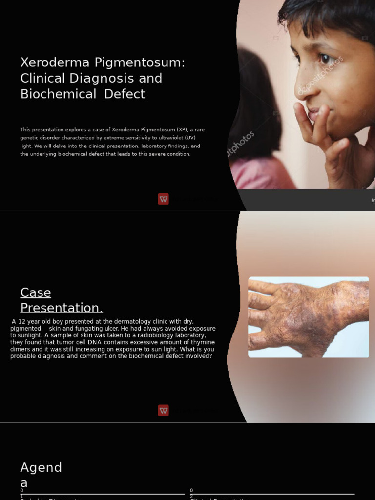 Xeroderma Pigmentosum Diagnosis Insights | PDF | Dna Repair | Genetics