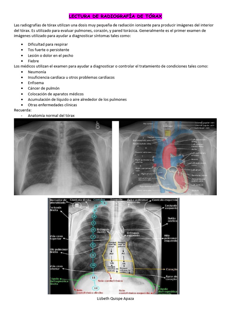 LECTURA_DE_RADIOGRAFiA_DE_ToRAX | PDF | Tórax | Pulmón