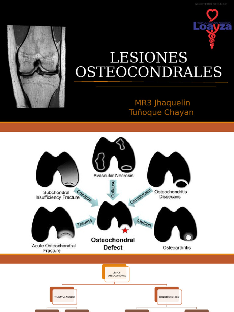 Lesiones Osteocondrales de Rodilla | PDF