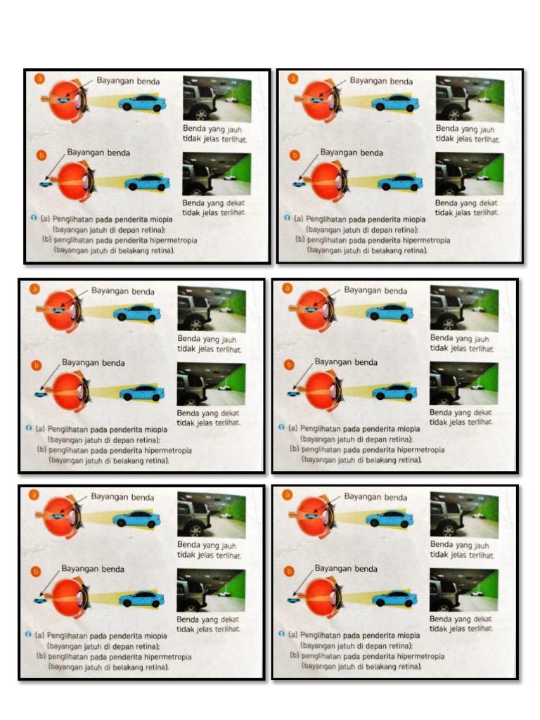 Hipermetropi Dan Miopi | PDF