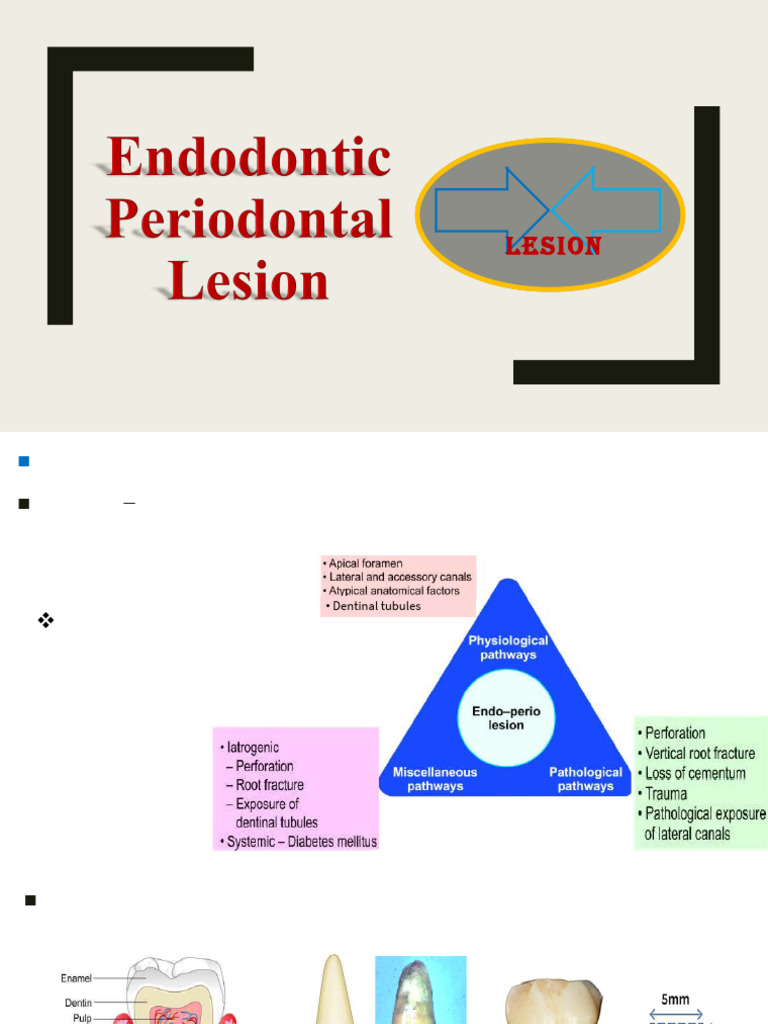Endodontic Periodontal Lesion | PDF | Periodontology | Dental Anatomy