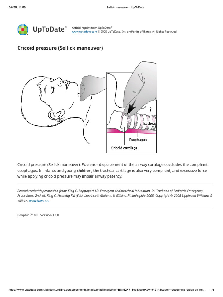 Sellick Maneuver - UpToDate | PDF