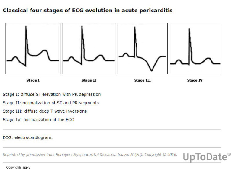 Classical Four Stages of ECG Evolution in Acute Pericarditis | PDF