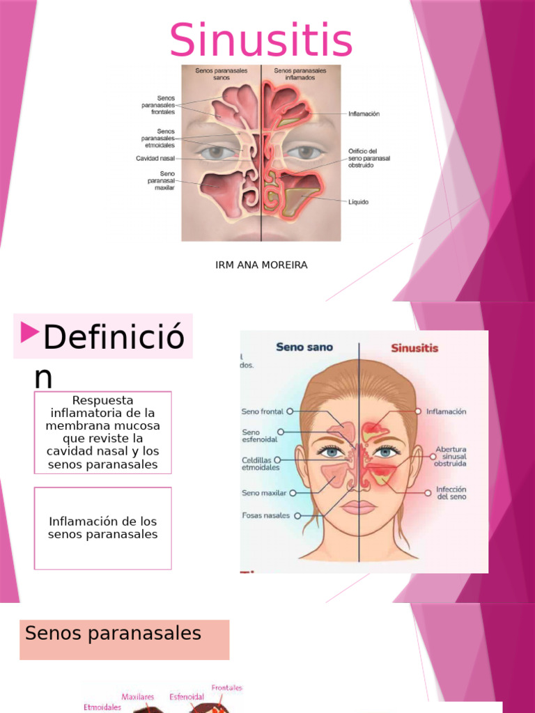 Clasificación y Diagnóstico de Sinusitis | PDF | Enfermedades y ...