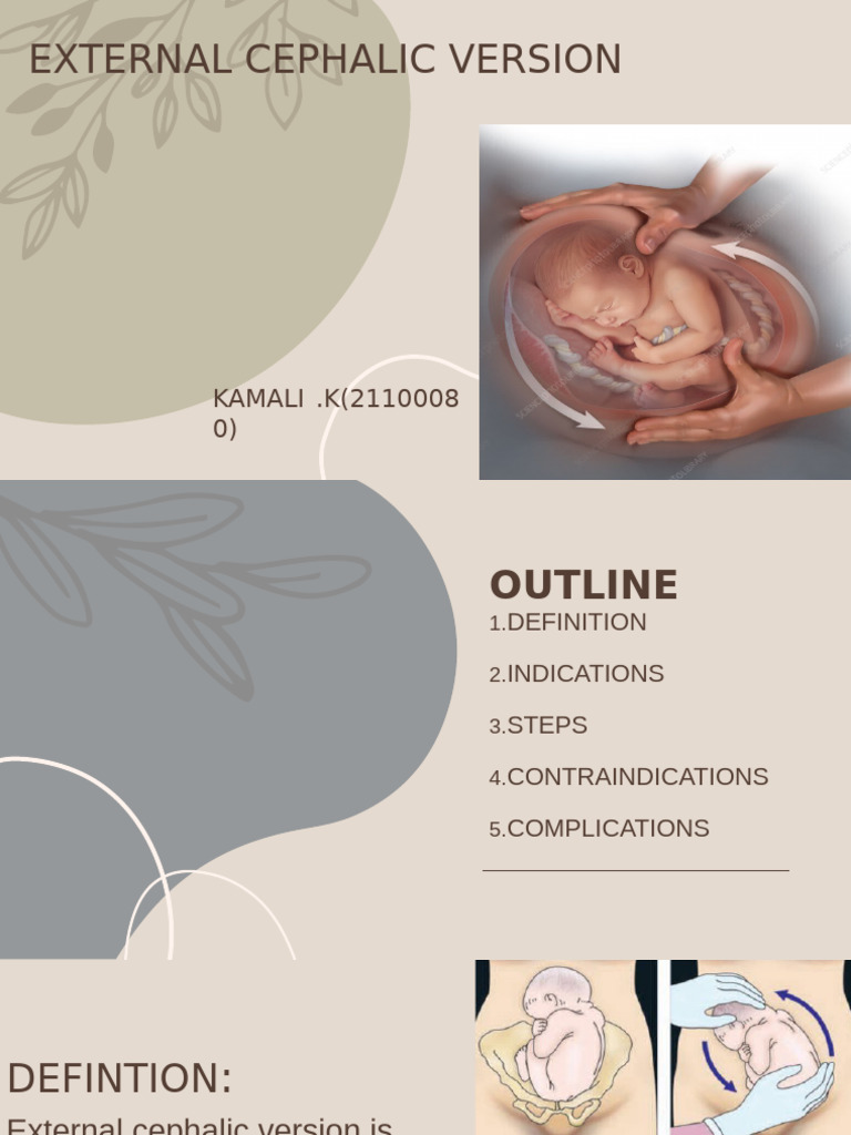External Cephalic Version | PDF | Human Reproduction | Mammalian Pregnancy