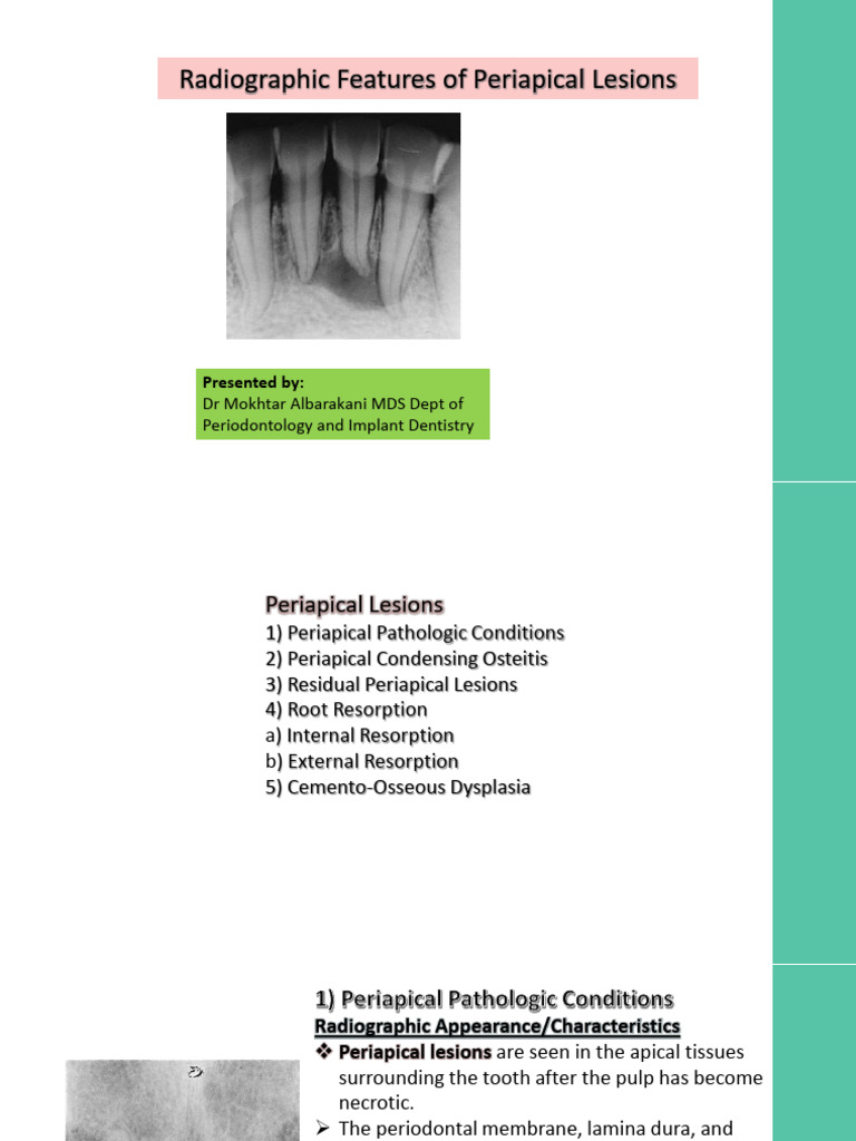 Radiographic Features of Periapical Lesions - 241222 - 172052 | PDF ...