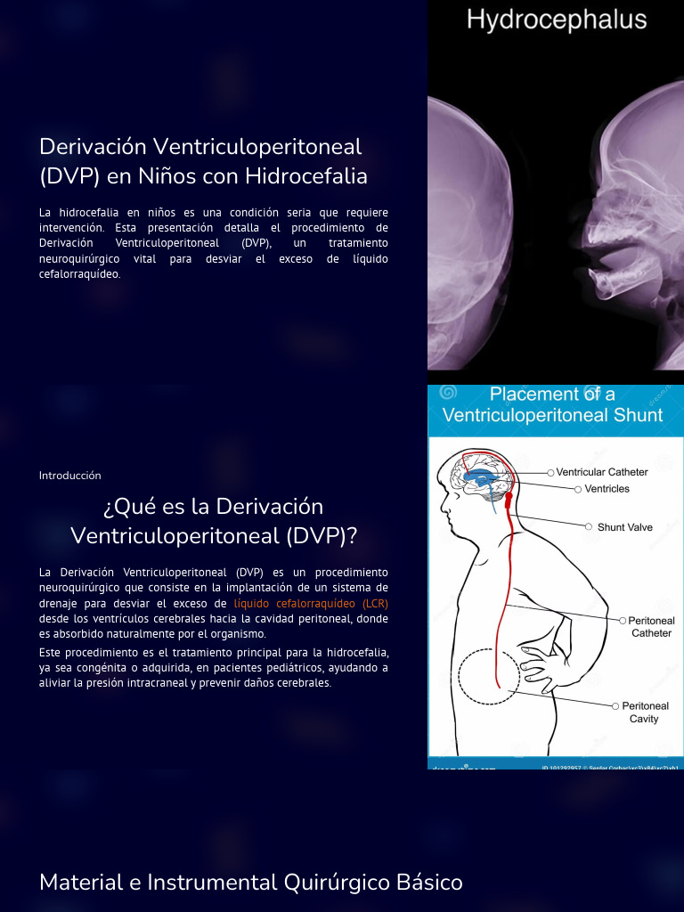 Derivacion Ventriculoperitoneal DVP en Ninos Con Hidrocefalia | PDF | Enfermedades y trastornos ...