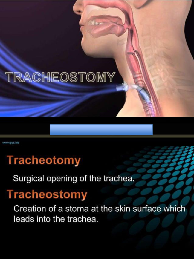 Tracheostomy | PDF