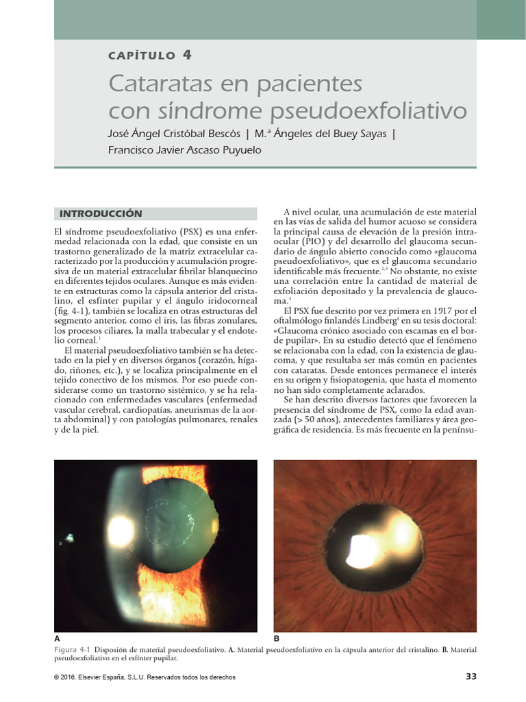 2016 Cap 04 Cataratas en Pacientes Con Sindrome Pseudoexfoliativo | PDF ...