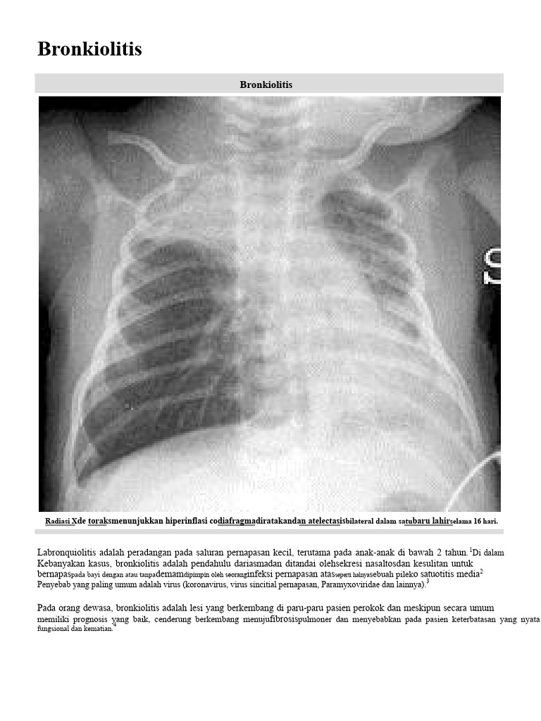 Bronkiolitis | PDF