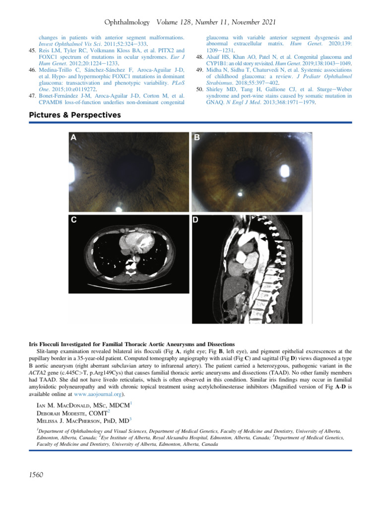 Iris Flocculi Investigated for Familial Thoracic A | PDF | Glaucoma ...