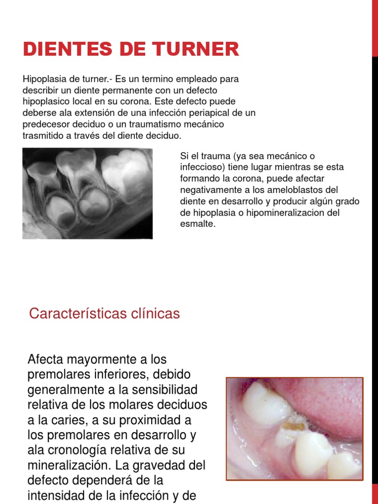 Dientes de Turner