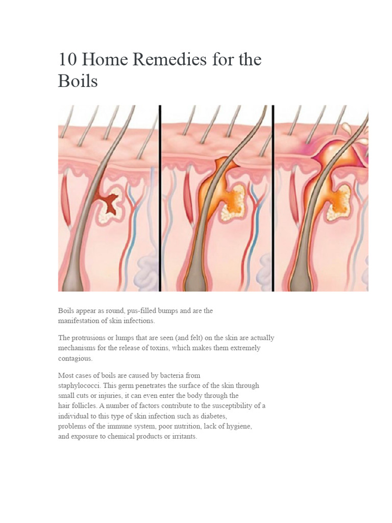 Home Remedies for Boils and Furuncles | PDF