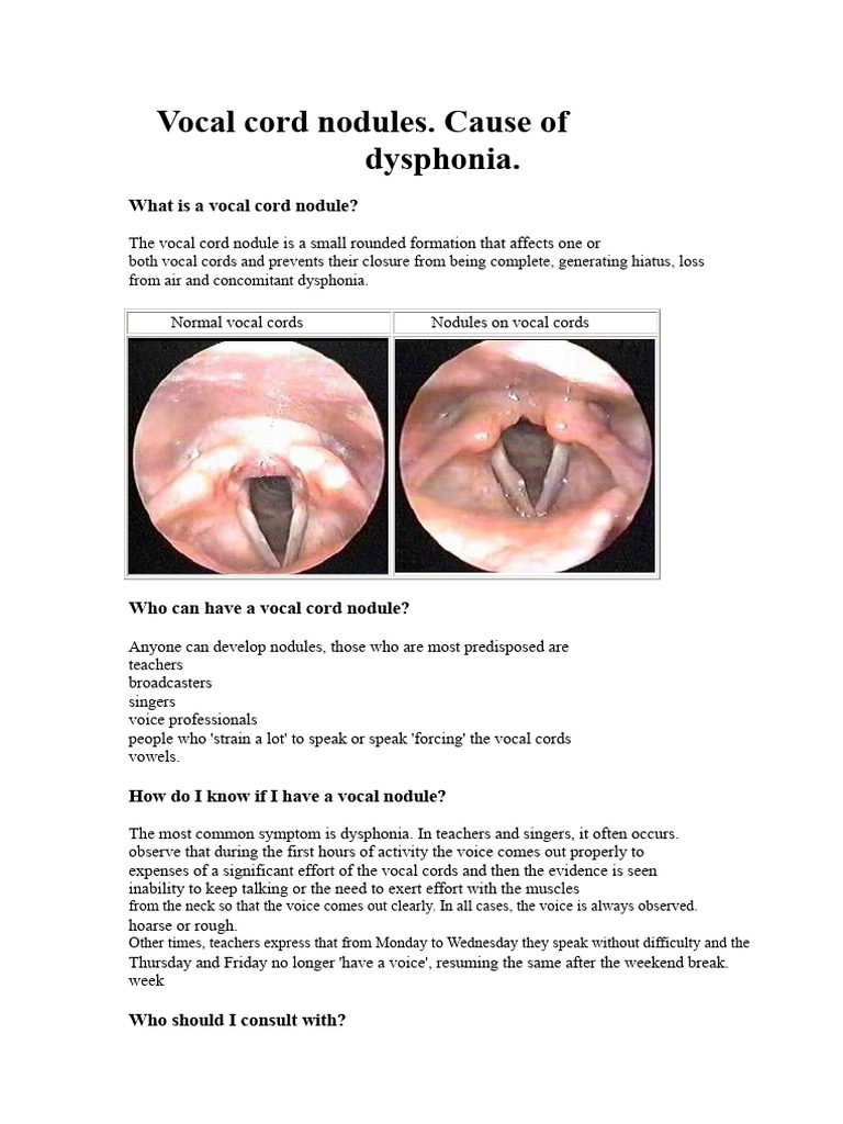 Vocal Cord Nodules | PDF | Human Voice | Medical Specialties