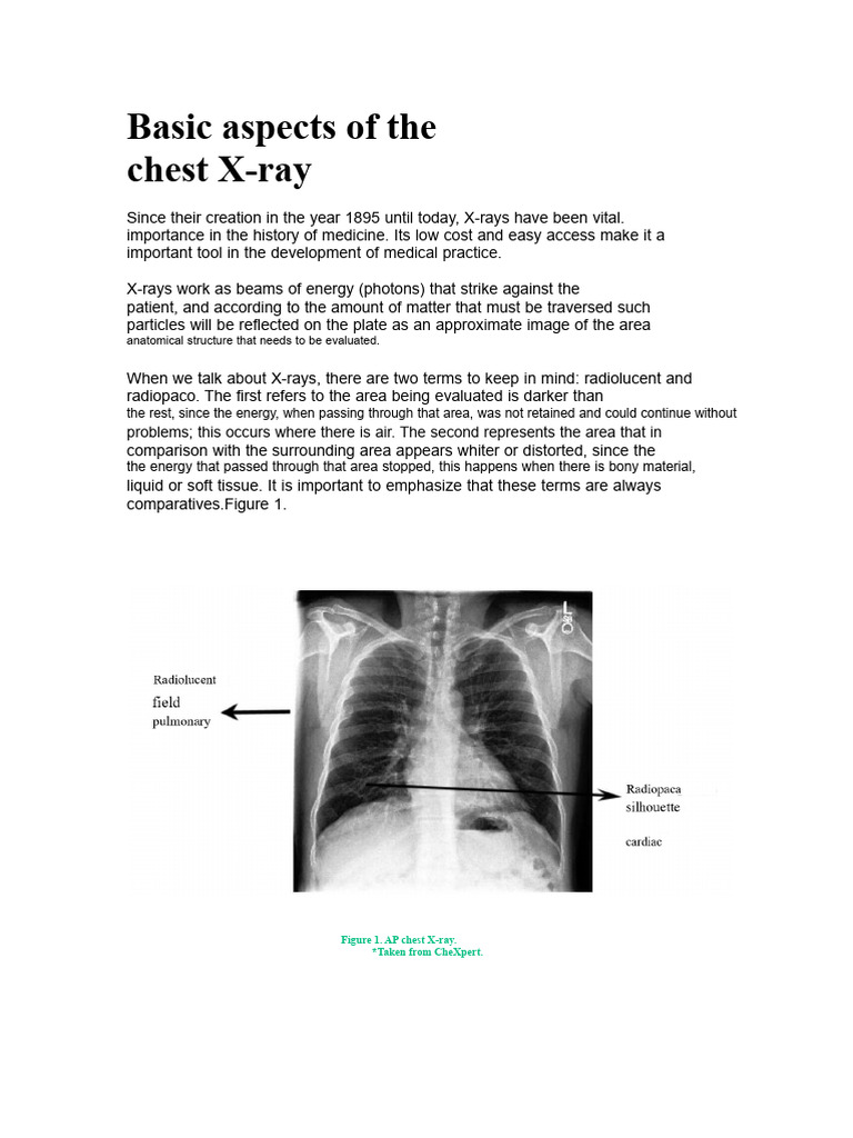 Understanding Chest X-Ray Basics | PDF | Lung | Thorax