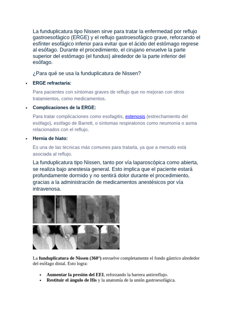 Funduplicatura de Nissen: Técnica Quirúrgica | PDF | La enfermedad por ...
