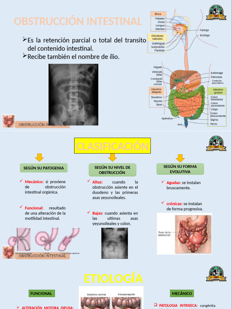 Obstruccion Intestinal | PDF | Especialidades Medicas | Enfermedades y ...