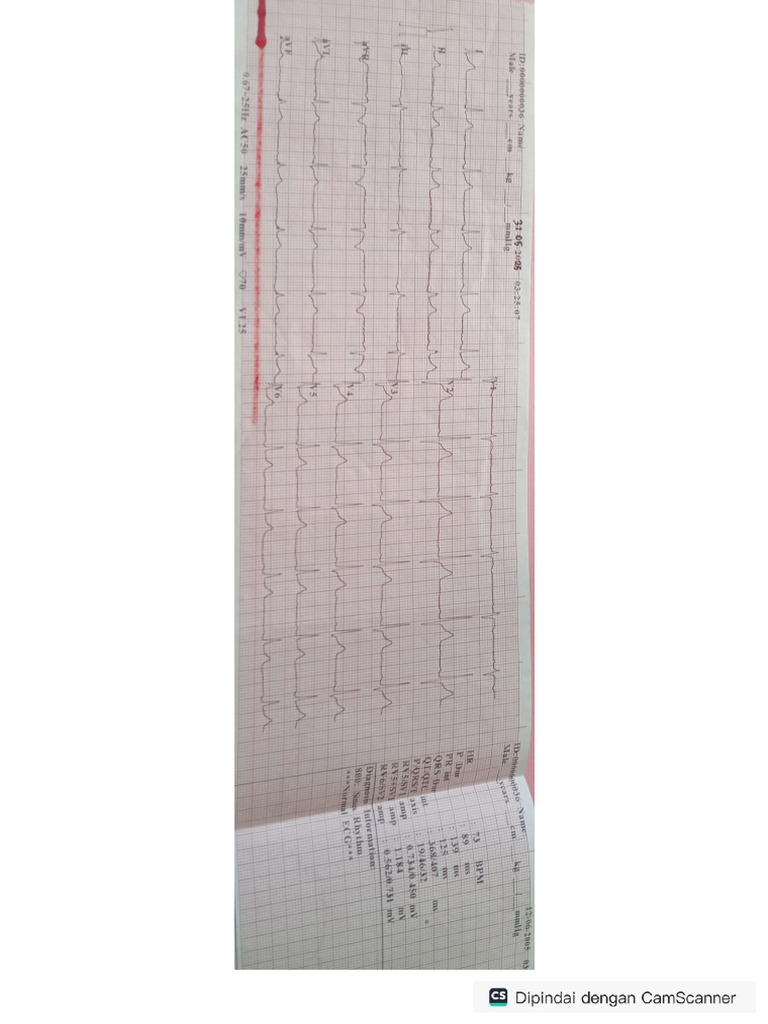 EKG, Thorax Sdr. Riki Nurcipta | PDF