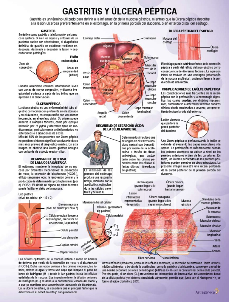 Gastritis y Ulcera Peptica | Úlcera péptica | Estómago