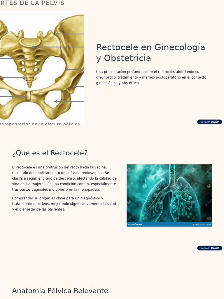 Rectocele en Ginecologia y Obstetricia | PDF | Vagina | Parto