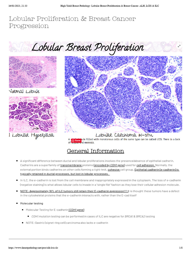 High Yield Breast Pathology - Lobular Breast Proliferation & Breast Cancer - ALH, LCIS & ILC ...