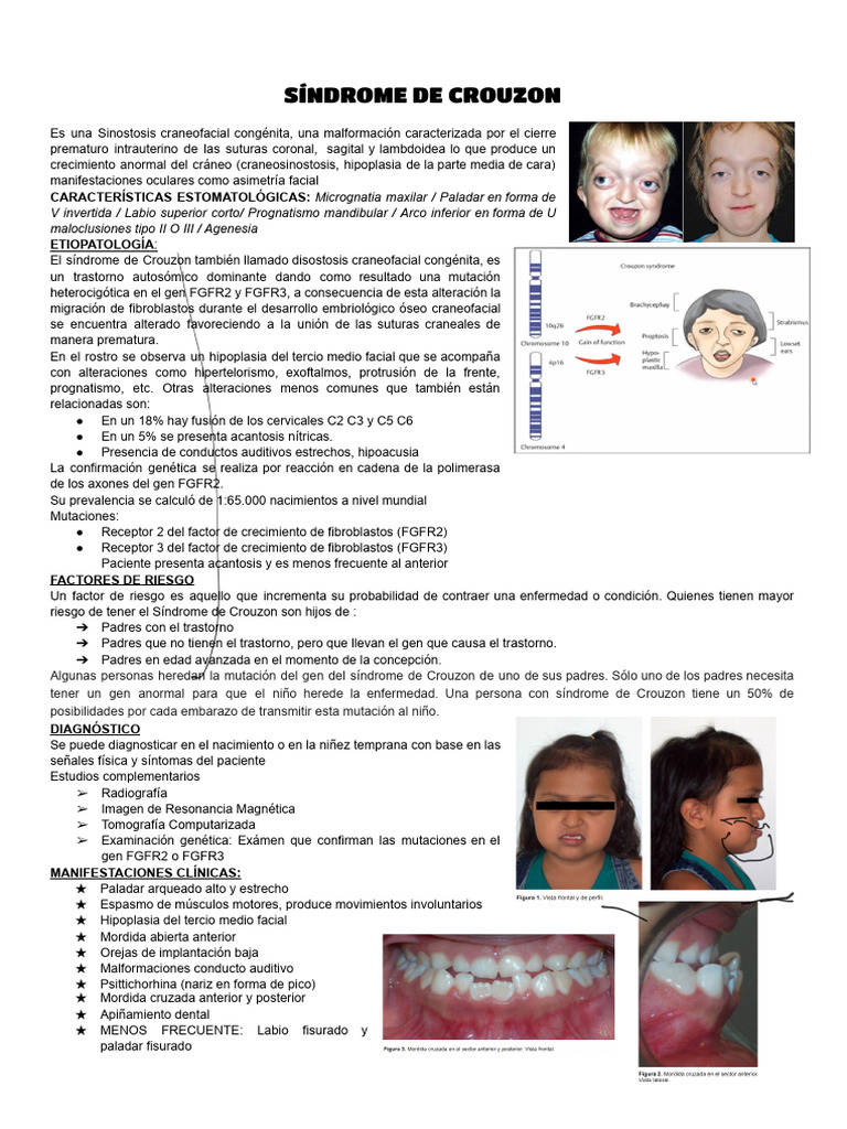 Síndrome de Crouzon | PDF | Enfermedades y trastornos | Especialidades ...