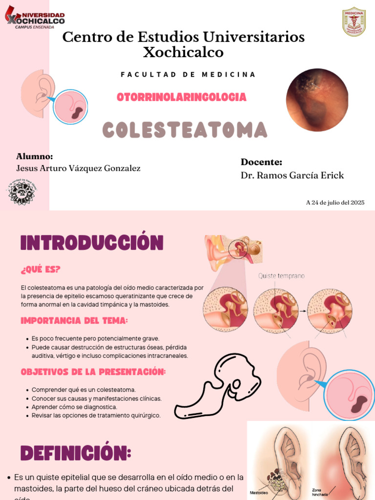 Colesteatoma: Diagnóstico y Tratamiento | PDF | Oído | Escuchando